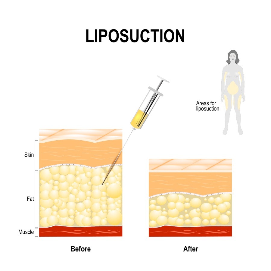 Liposuction Greensboro: Where to Go and What to Expect - Betterauds.com